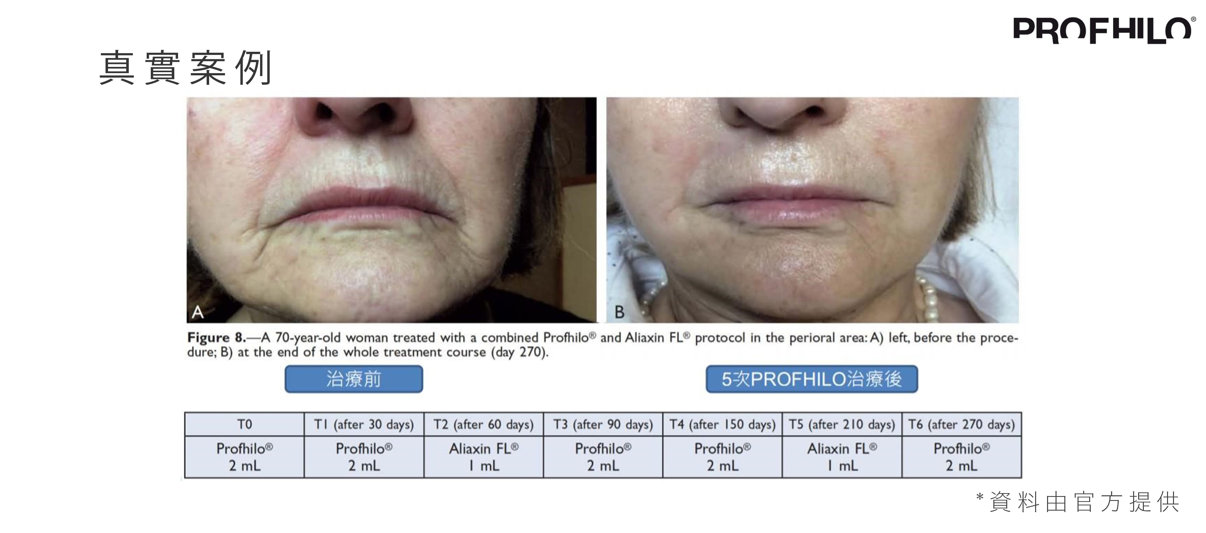 Profhilo 逆時針 | 透明質酸針 | 激活膠原逆轉肌齡 - Medskin Plus